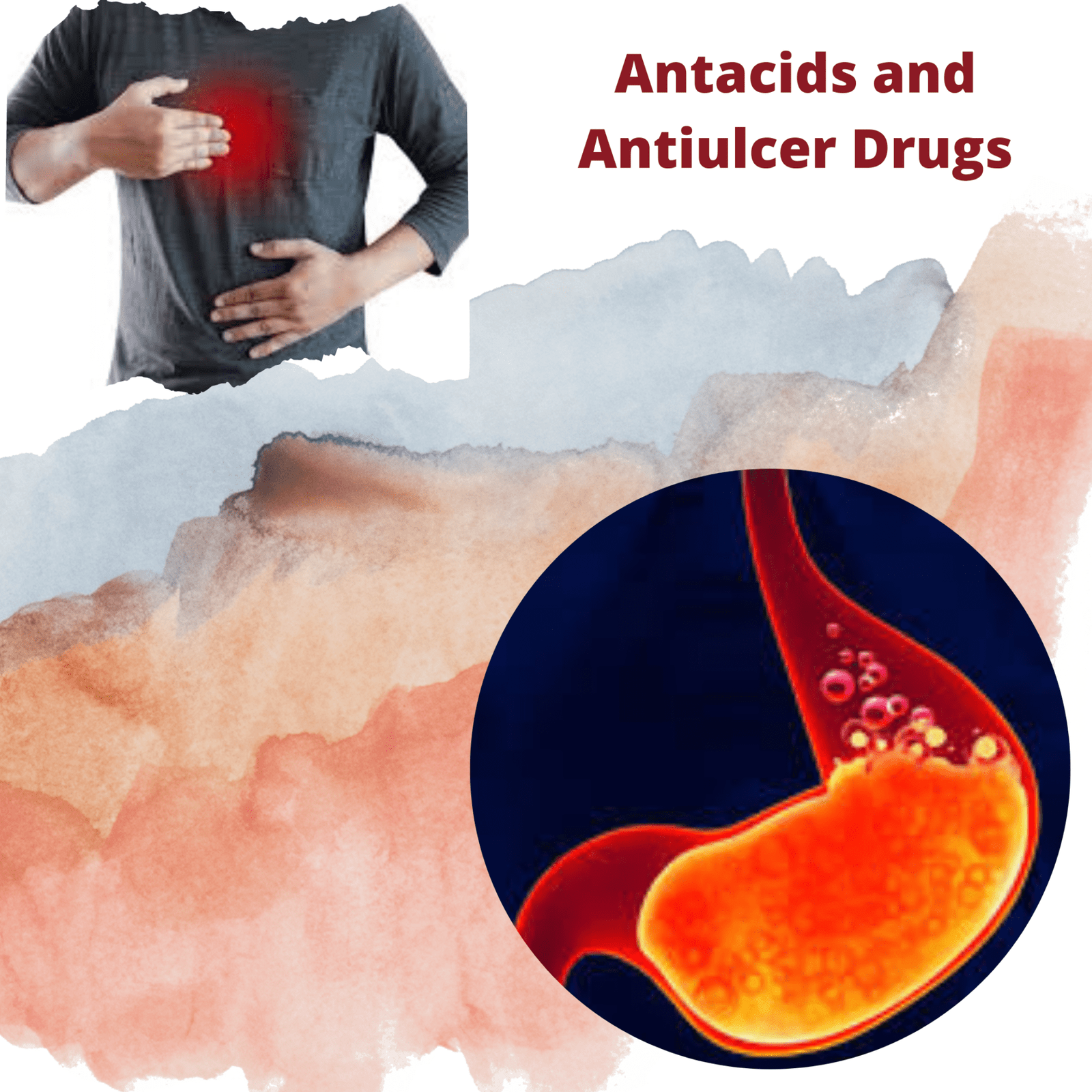Ulcers in the stomach- How is it treated? > PharmaCampus