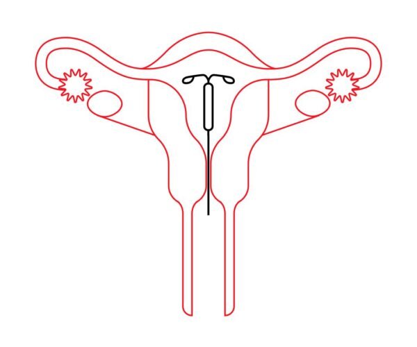 IUD (Intrauterine Device) Applications > PharmaCampus